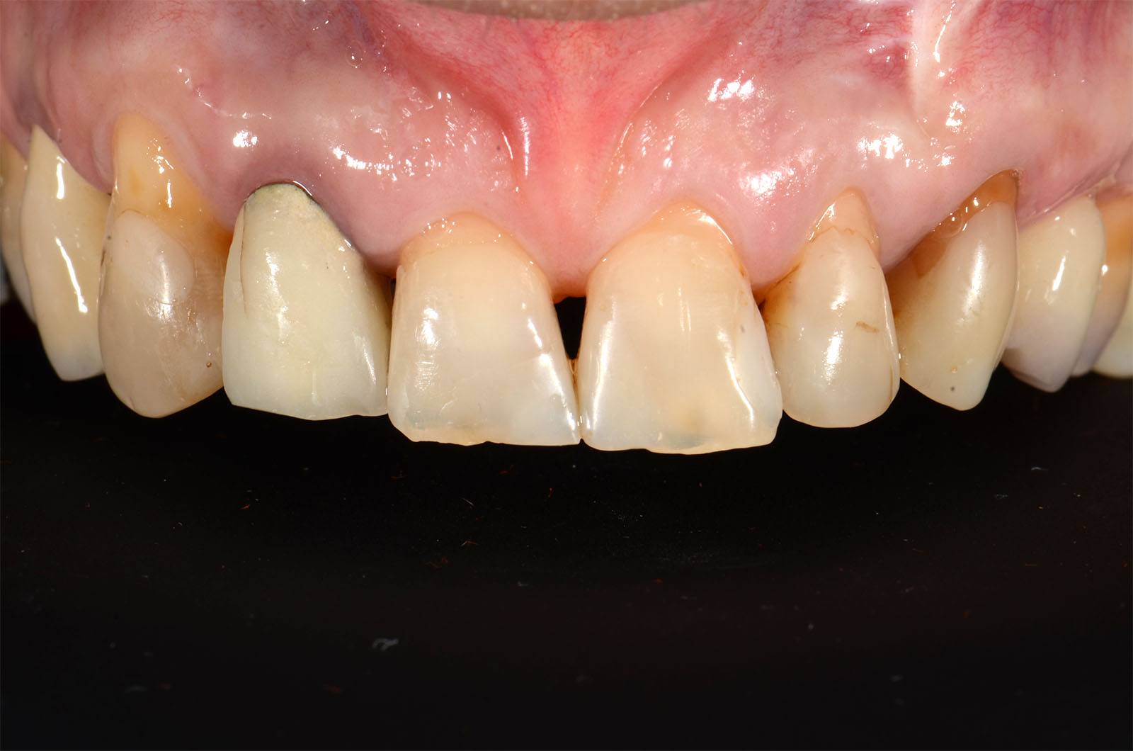 Corone Dentali in Ceramica Integrale - Dr. Bombardelli, Trento